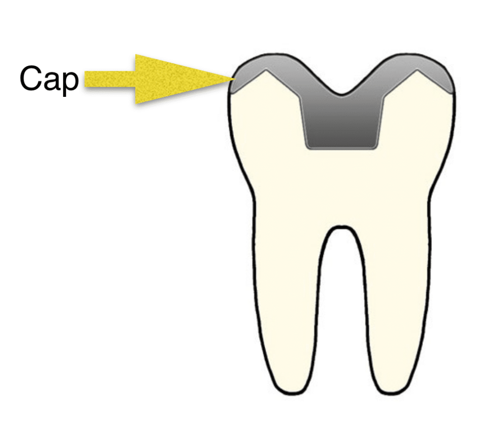 What is capping? | Supa Dental, Melton VIC 3337