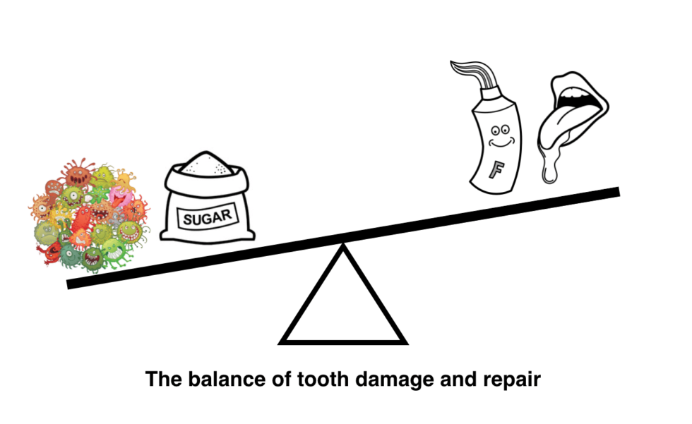 Why some people get holes in their teeth and others don’t | Supa Dental ...
