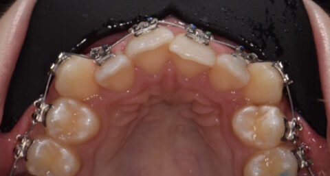 Metal Braces Melton | Melton Dentist | Supa Dental